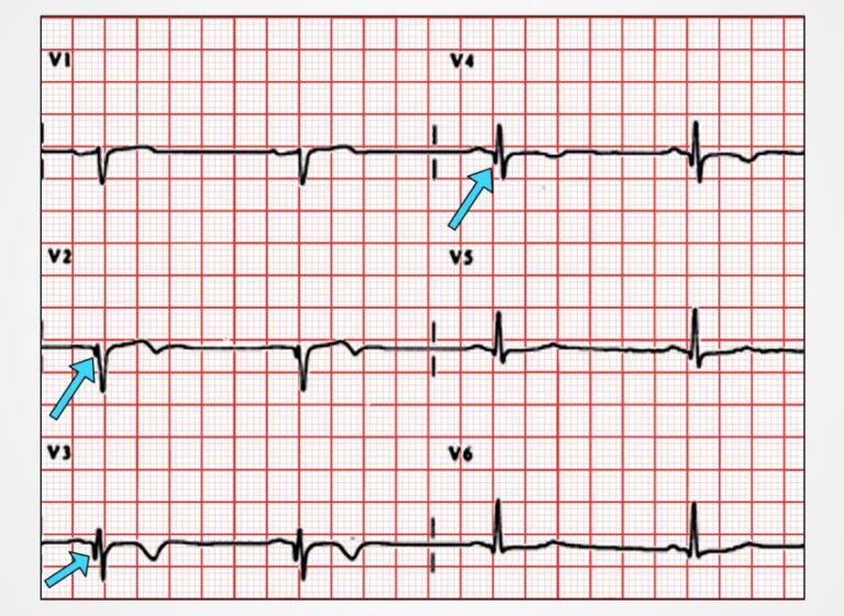 EKG - Q talas - Moja Medicina